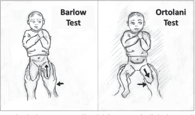 What is the Barlow Test and How is it Performed? - Heal Cure